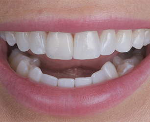 The Mini Smile Makeover with maximum results - StyleNest